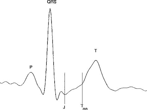 Figure 1 From A Qrs Estimator Using Linear Prediction Approach