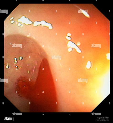 Colonic Bleeding Endoscope View Of A Bleeding Diverticulum In The