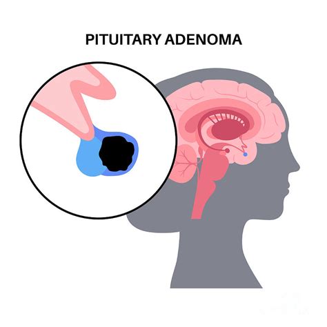 Pituitary Adenoma Cancer Photograph By Pikovit Science Photo Library Pixels