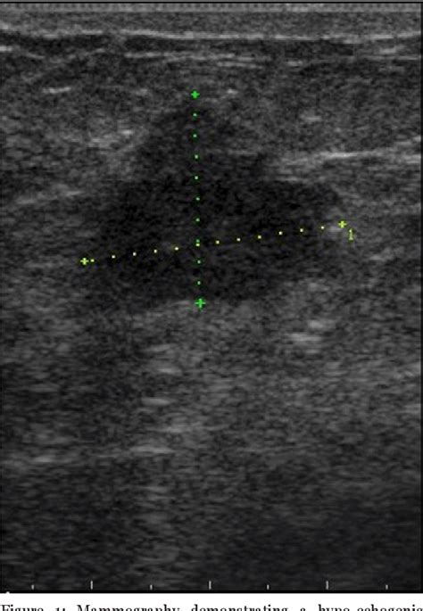 Figure 1 From Ocular Flutter As The First Sign Of A Breast Carcinoma Semantic Scholar