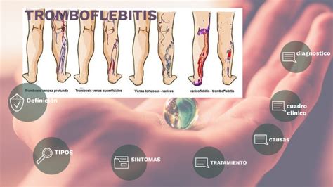 Tromboflebitis By Sarahi Garcia On Prezi
