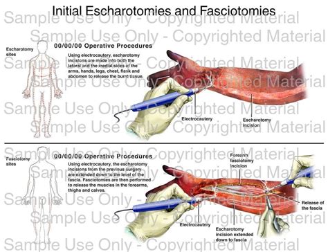 Escharotomy Vs Fasciotomy Egyptian Plastic Surgery Academy