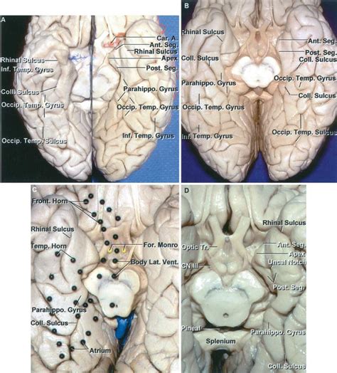 Basal Surface Of The Temporal And Occipital Lobes From Two Different
