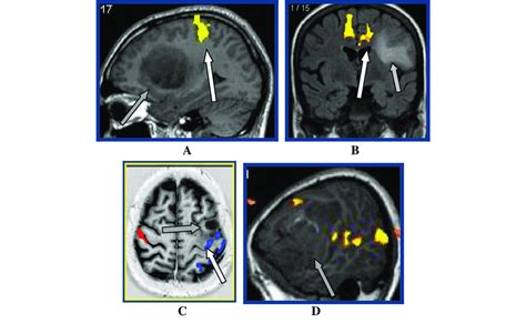 Different Relations Between The Eloquent Brain Areas And The Brain Download Scientific Diagram