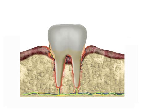 What Is A Suprabony Periodontal Pocket At George Hodge Blog
