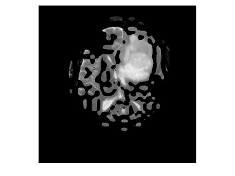 Brain Tumor Segmentation Using Morphological Processing And The