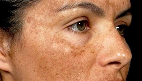 دلایل لکه های قهوه ای روی پوست روش درمان سفیر زیبایی