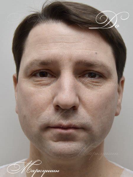 Фото до и после блефаропластики трансконъюнктивальной Пластический хирург Маркушин