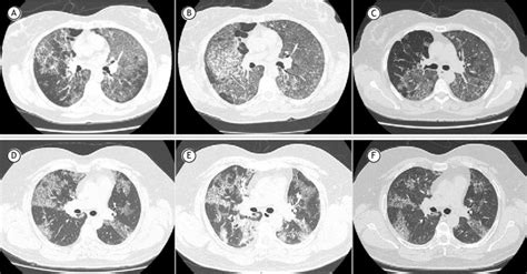 Chest Ct Scans Showing Bilateral And Diffuse Ground Glass Opacities Download Scientific Diagram