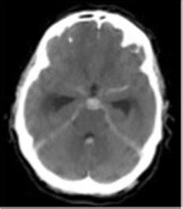 CT Brain Scan Demonstrating Subarachnoid Blood Concentrated In The Download Scientific Diagram