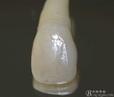 离体牙树脂修复 Aimee的博客 KQ88口腔博客