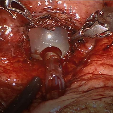 Three Way Catheter Is Placed In The Prostatic Fossa Download Scientific Diagram