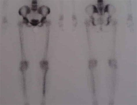 Diagnosis Of Shin Splint A Case Report Published In Surgicoll