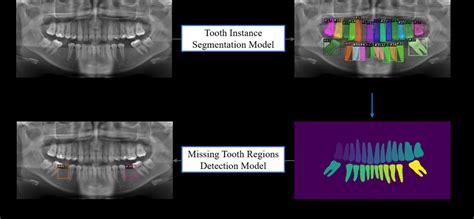 Entire Process For Missing Tooth Region Detection Tooth Instance Download Scientific Diagram