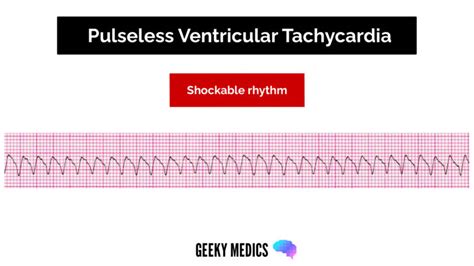 Shockable Vs Non Shockable Rhythms In Cardiac Arrest Geeky Medics