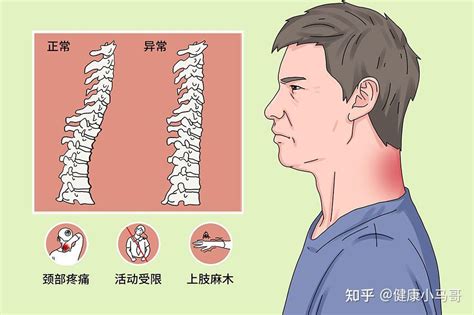 颈椎生理曲度变直是怎么回事 低头族当心 知乎
