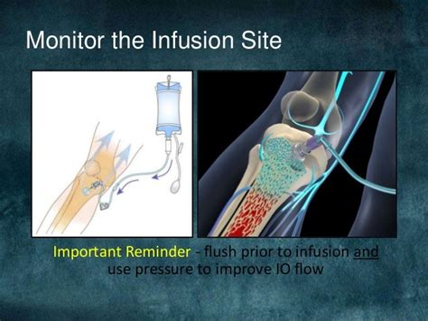 Intraosseous Infusion Mhs 536