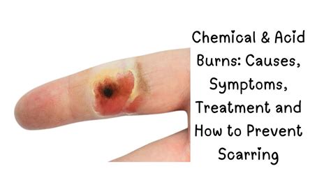 Chemical And Acid Burns Causes Symptoms Treatment And How To Prevent