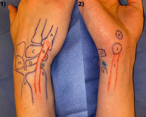 Ulnar Wrist Pain Pregnancy At David Kemp Blog