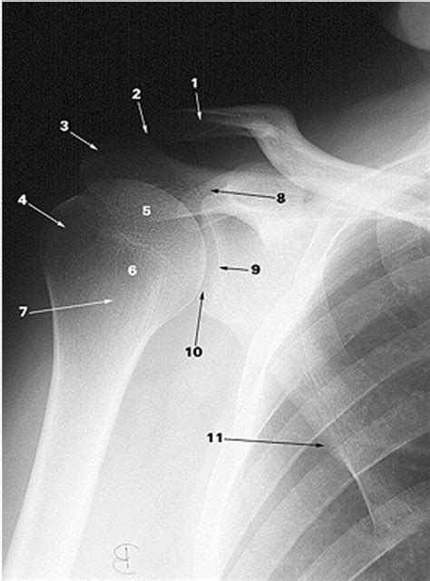 Shoulder Radiograph Diagram Quizlet