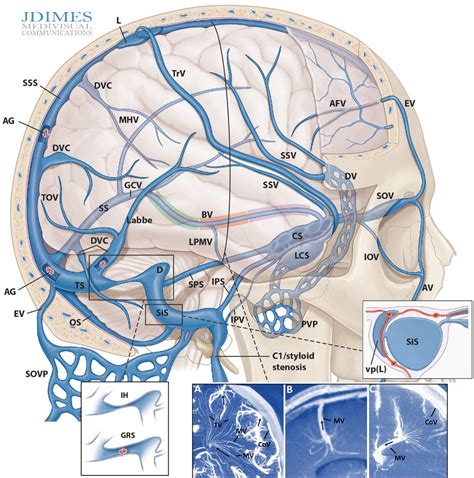 Cerebral Venous Anatomy Implications For The Neurointerventionalist
