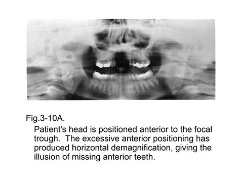 Positioning Errors In Panoramic Radiography Pdf