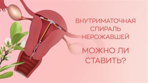 📌 Внутриматочная спираль нерожавшей можно ли ставить Youtube