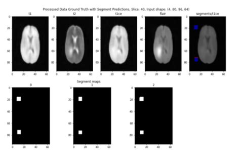 Ground Truth Output Loss And Dice Loss Go To Zero · Issue 45 · Iamsuyogjadhav 3d Mri Brain