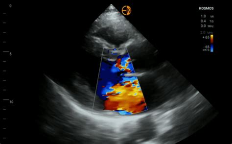 Mitral Valve Fibroelastoma With Echocardiogram