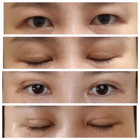 절개쌍커풀 수술후 자연유착으로 재수술 리얼후기 눈이 예쁘다 그래서 아몬드성형외과