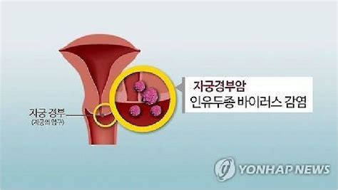 자궁경부암 백신 남자청소년 접종은 비용 대비 효과성 없어 노컷뉴스