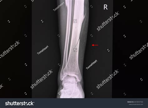 Broken tibia 3 768 รายการ ภาพ ภาพสตอกและเวกเตอร Shutterstock