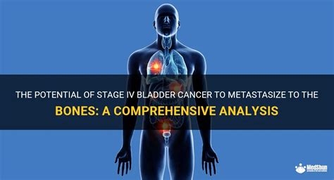The Potential Of Stage Iv Bladder Cancer To Metastasize To The Bones A