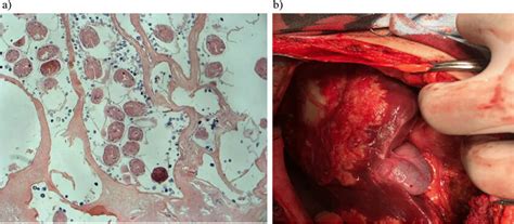 A B After Diagnostic Laparotomy Histologic Examination Was Carried