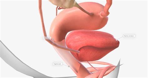 Gonorr Ia Uma Infec O Sexualmente Transmiss Vel Causada Pela Bact Ria Neisseria Gonorrhoeae