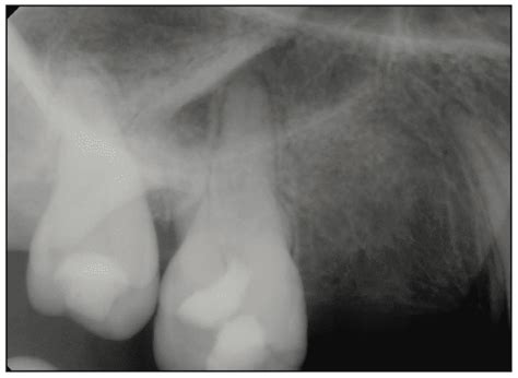 Ridge Expansion Osteotomy A Combination Technique Dentistry Today