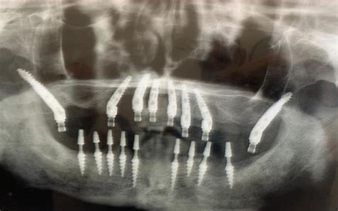 Best Pterygoid Dental Implants Clinic In Delhi Ncr India Best Dental