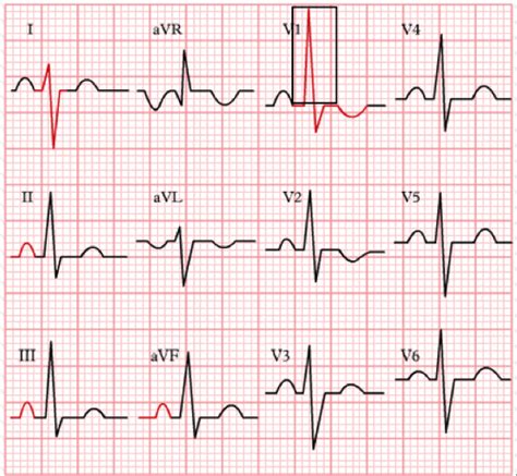 Ventricular Hypertrophy Flashcards Quizlet
