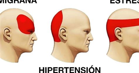Tipos De Dolores De Cabeza Y Causas Enfermedades Y Afecciones 2021