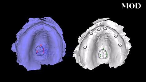 Align 3d Meshes With Tissue Tracker All On X Dental Ce Video Mod