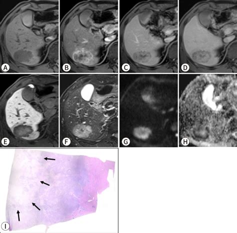 Imaging Findings Of Intrahepatic Cholangiocarcinoma For Prognosis Prediction And Treatment