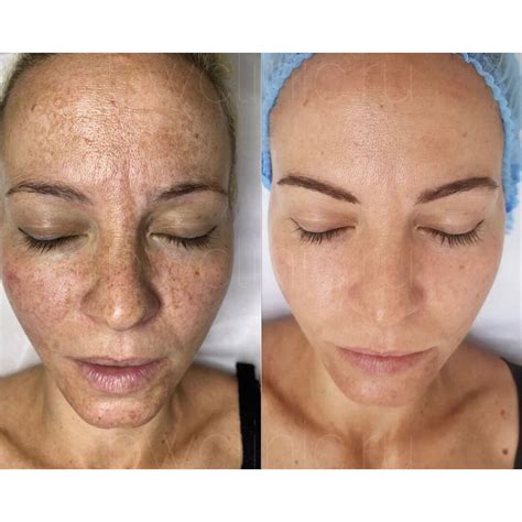 Удаление пигментных пятен на лице лазером цены в Москве Убрать