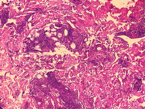 Photomicrograph Showing Patchy Infiltration By Epithelioid Cells And