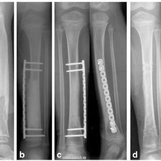 Case Y Repeated Swelling And Skin Ulcer Of The Right Proximal Download Scientific