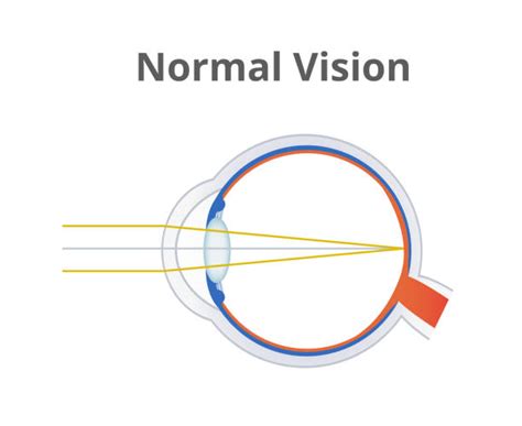 Myopia Diagram Stock Vectors Istock