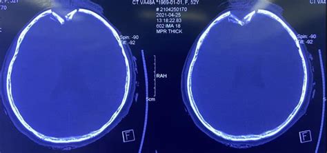 额部开放凹陷性骨折 脑医汇