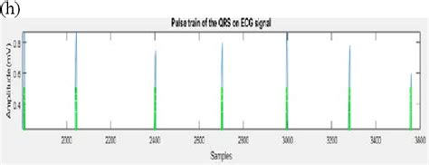 Figure 3 From Matlab Based Gui For Ecg Arrhythmia Detection Using Pan