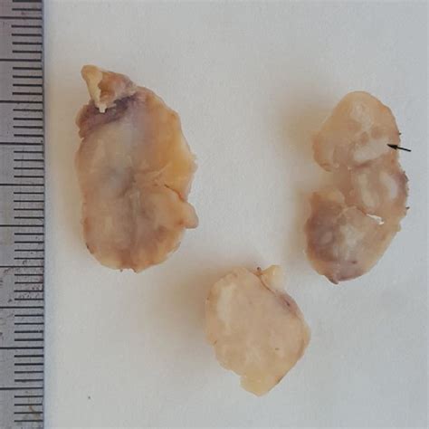 Macroscopic View An Illustrative Case Of Lymph Node Tuberculosis With