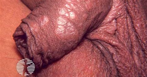 Genital Psoriasis Image