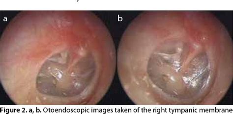 Tympanic Membrane Retraction
